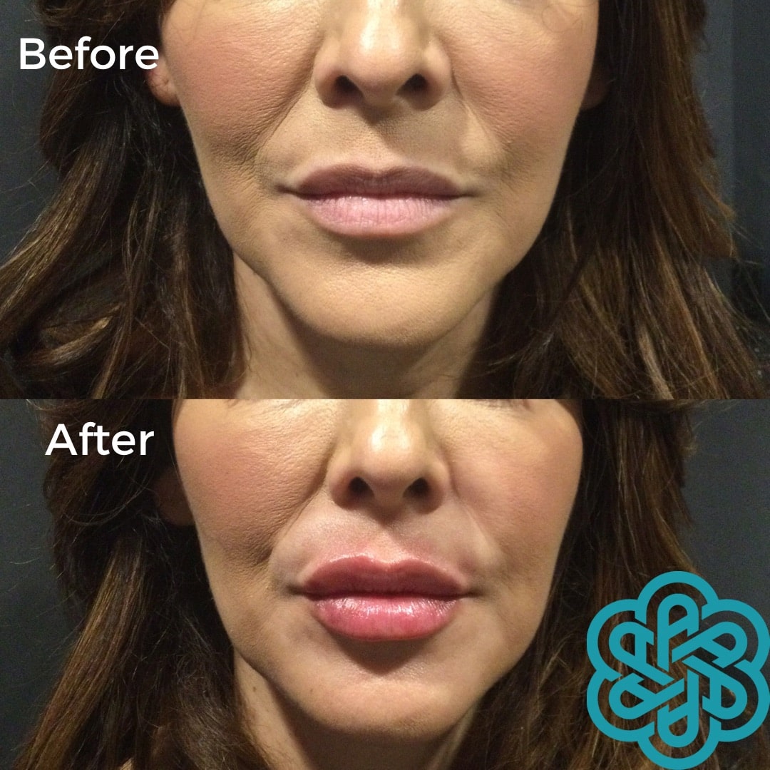 Before and After Gallery | Allure Anti-Aging & Aesthetics | Huntington ...